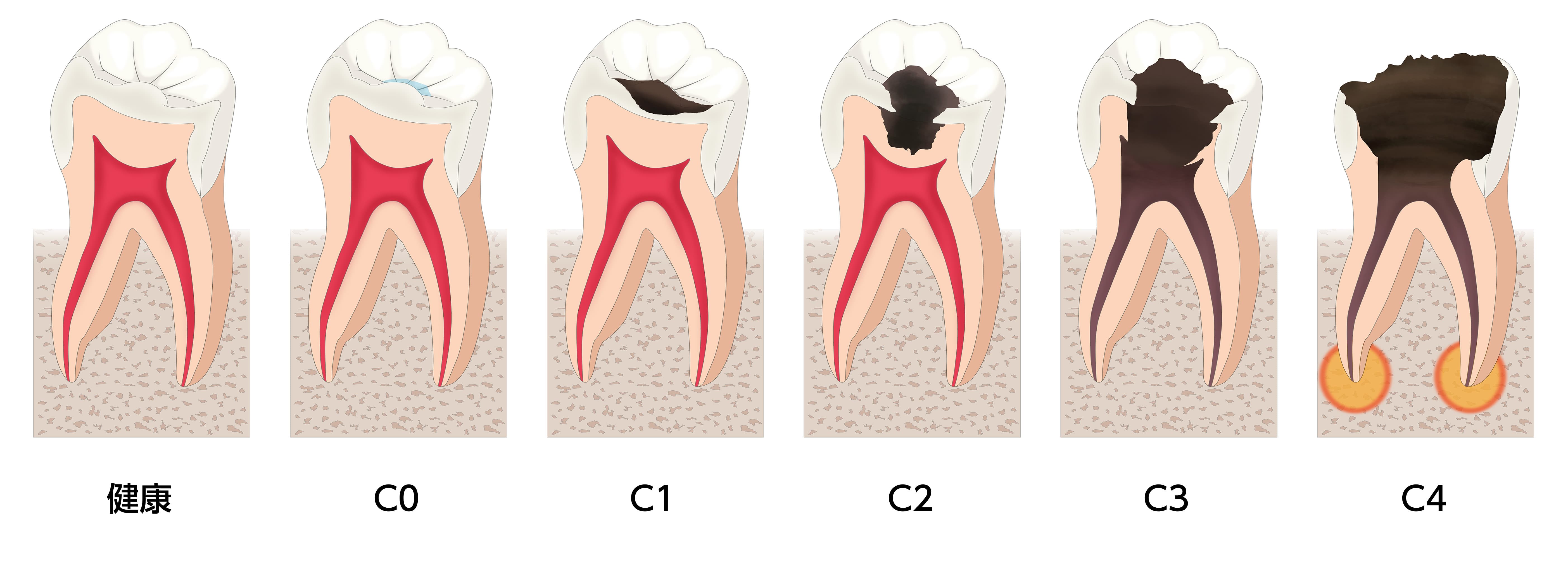 Dental Caries Progression at Margurite Stokes blog